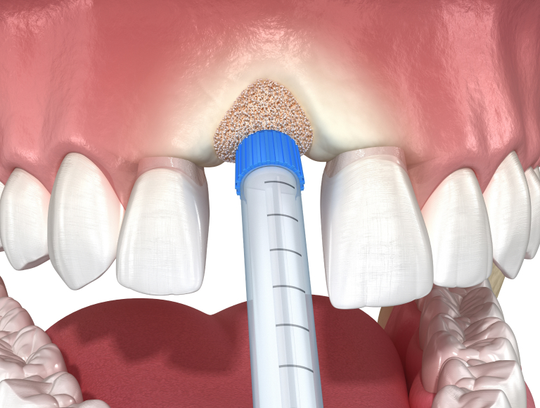 Bone Regeneration in El Paso, TX | El Paso Family Dental