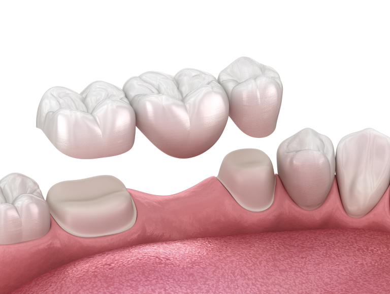 Quality Dental Bridges in El Paso, TX | El Paso Family Dental