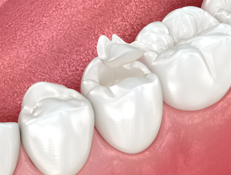 Inlays & Onlays in El Paso, TX | El Paso Family Dental